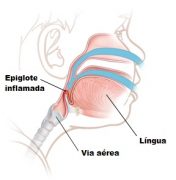 Epiglotite – ObservaPed