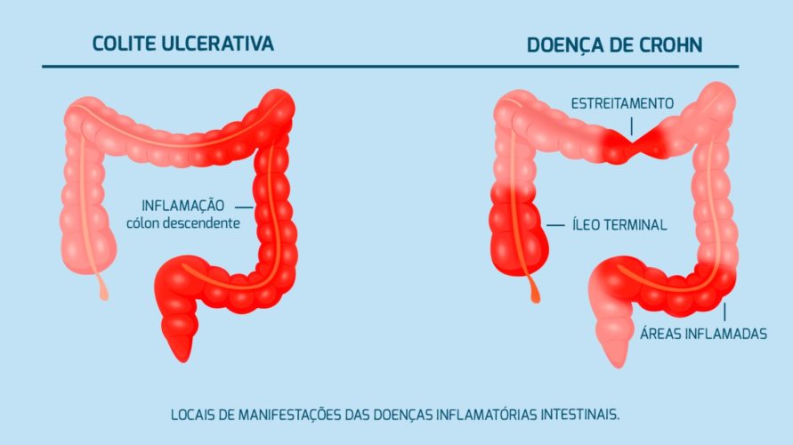 Doença Inflamatória Intestinal – ObservaPed
