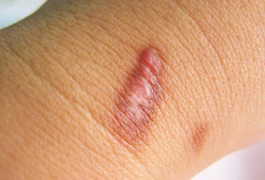 Queloide – ObservaPed