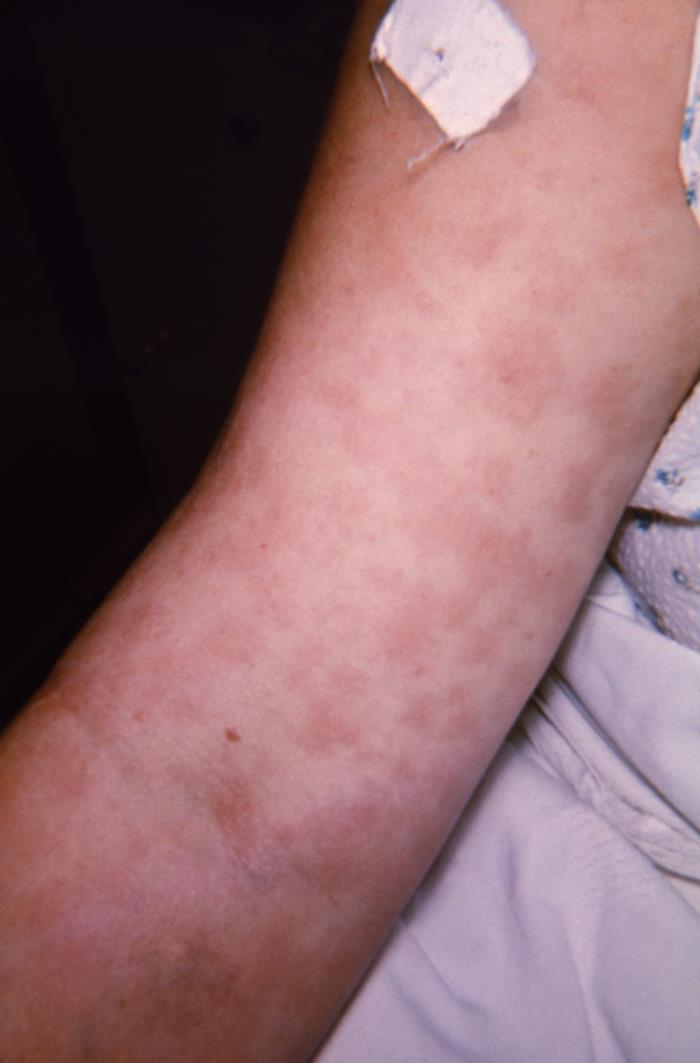 Exantema (doença exantemática) – ObservaPed