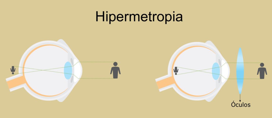Hipermetropia – ObservaPed