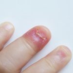 Paroníquia – ObservaPed