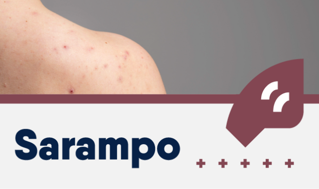 O sarampo ainda é uma doença eliminada? - Faculdade de Medicina da UFMG