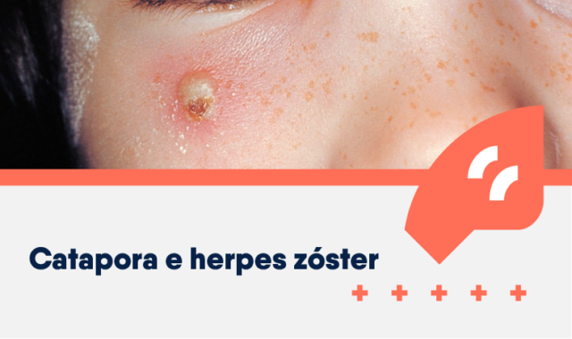 Varicela: um vírus, duas doenças - Faculdade de Medicina da UFMG